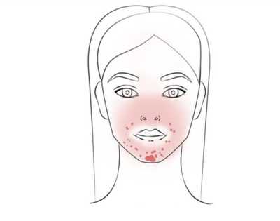 O que ajuda a tratar a dermatite perioral? | Descubra já! | FORMEL Skin