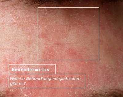 Eu tenho neurodermatite? | Descubra já! | FORMEL Skin